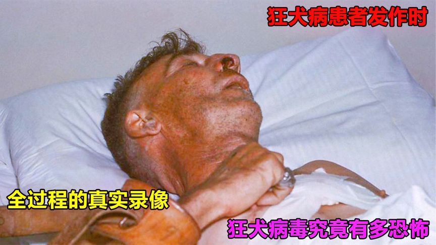狂犬病患者发作时,全过程的真实录像,狂犬病毒究竟有多恐怖?