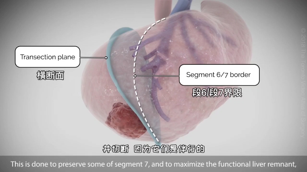 发生肝癌,肝切除手术怎么做,3D演示。