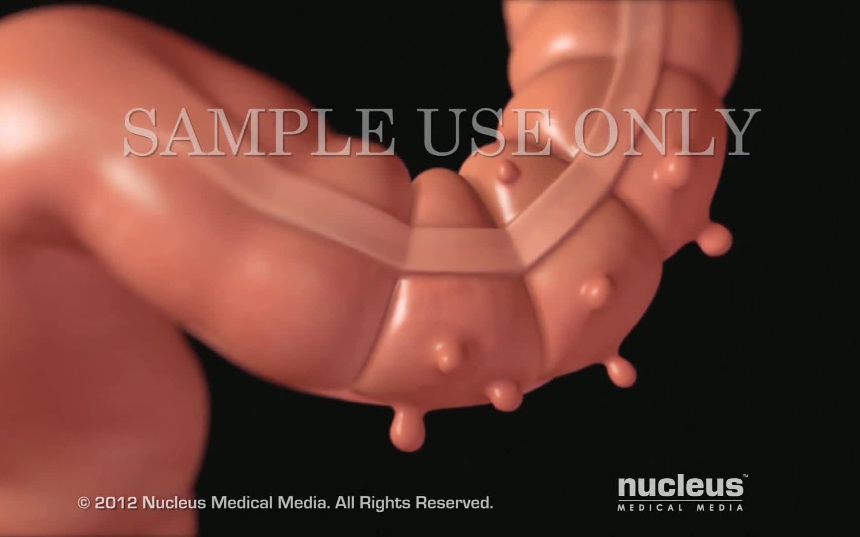 【3D医学动画】憩室病(中英双字幕)