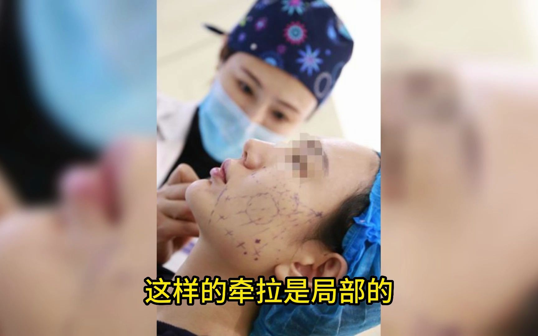 微拉美是啥,微拉美面部提升过程图