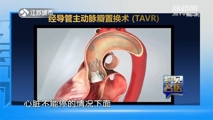什么是心脏瓣膜置换术?手术是怎么进行的?专家现场讲解