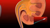 输尿管 10 输尿管支架管治疗输尿管梗阻 Ureteral Obstruction - ...