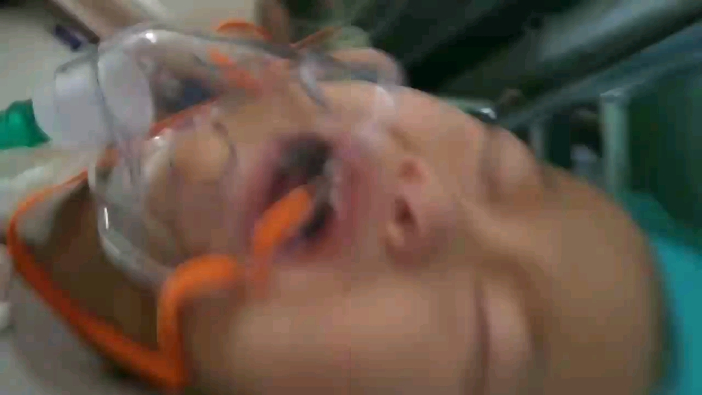 ...picc静脉置管术!胸口加了一个管子为了输液,也为了长期化疗保护血管