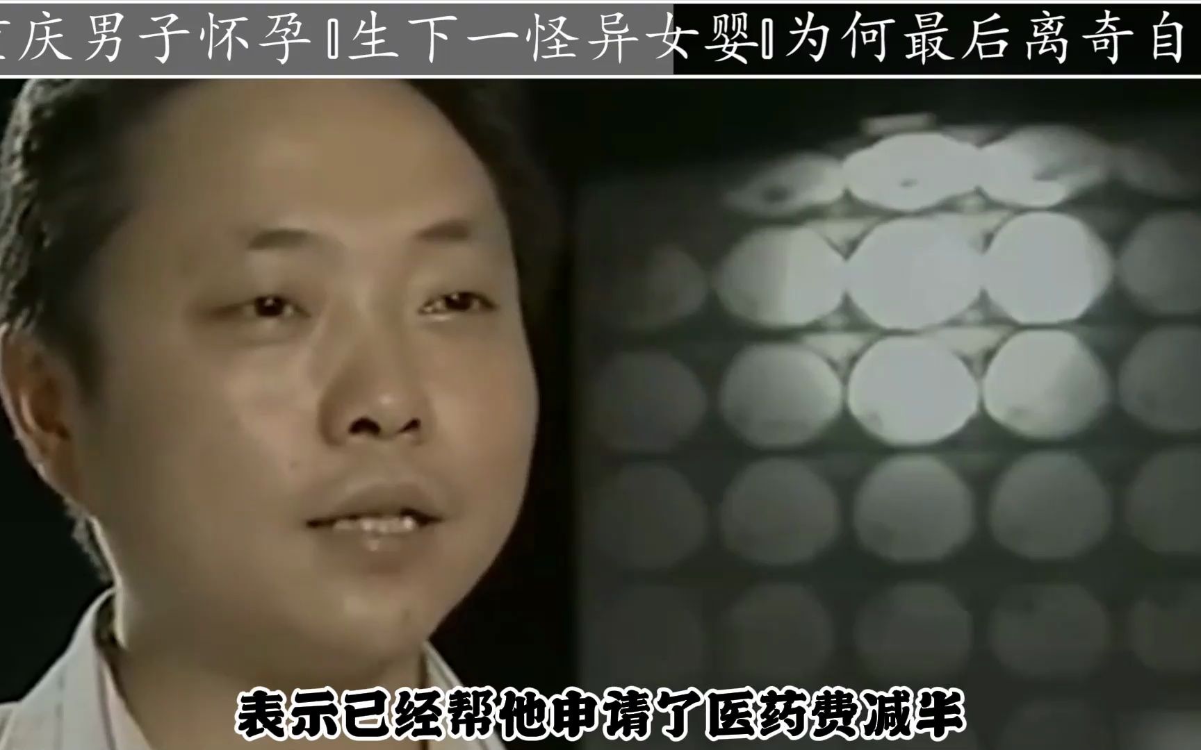重庆男子“意外怀孕”,产下“怪异女婴”,剖腹产手术后离奇自杀