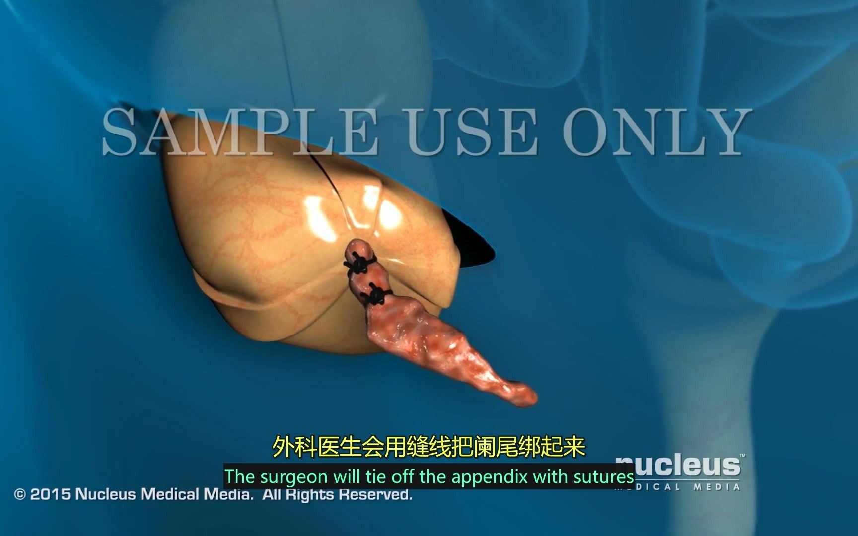 【3D医学动画】一个人阑尾发炎后,他有两种切除的方式选择(中英双...