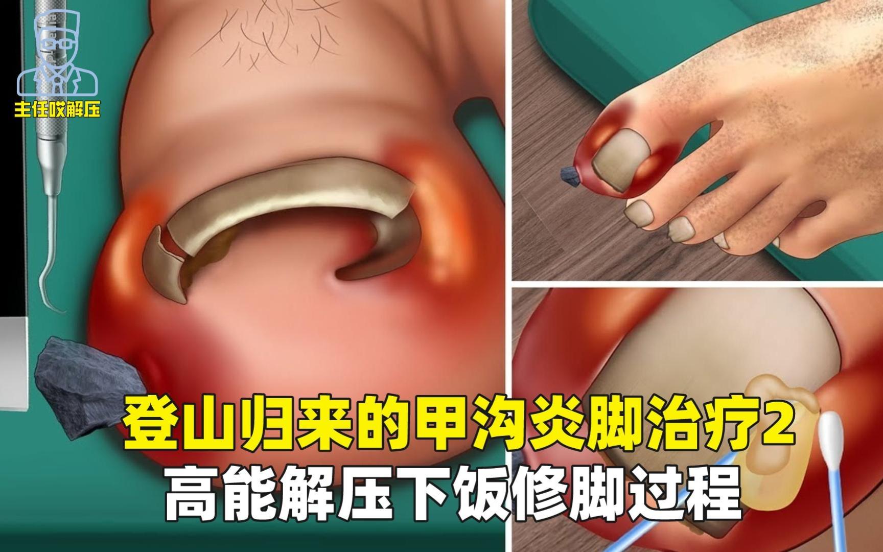解压动画,登山归来的甲沟炎脚治疗第二部,高能解压下饭修脚过程