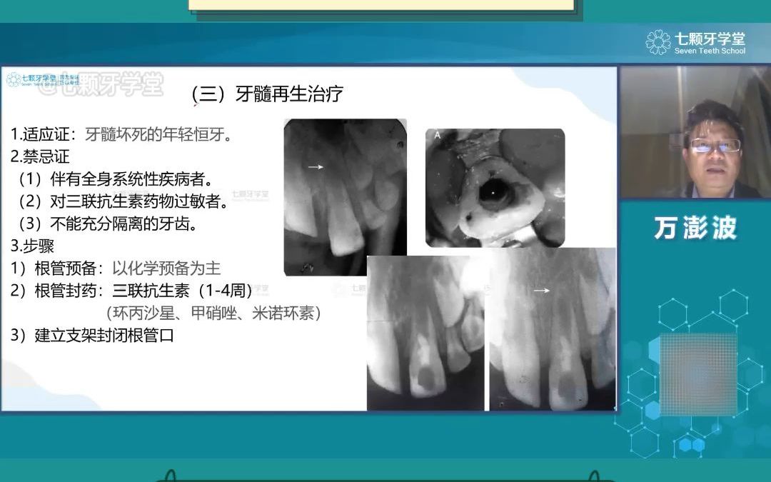 口腔主治口内-牙髓再生治疗