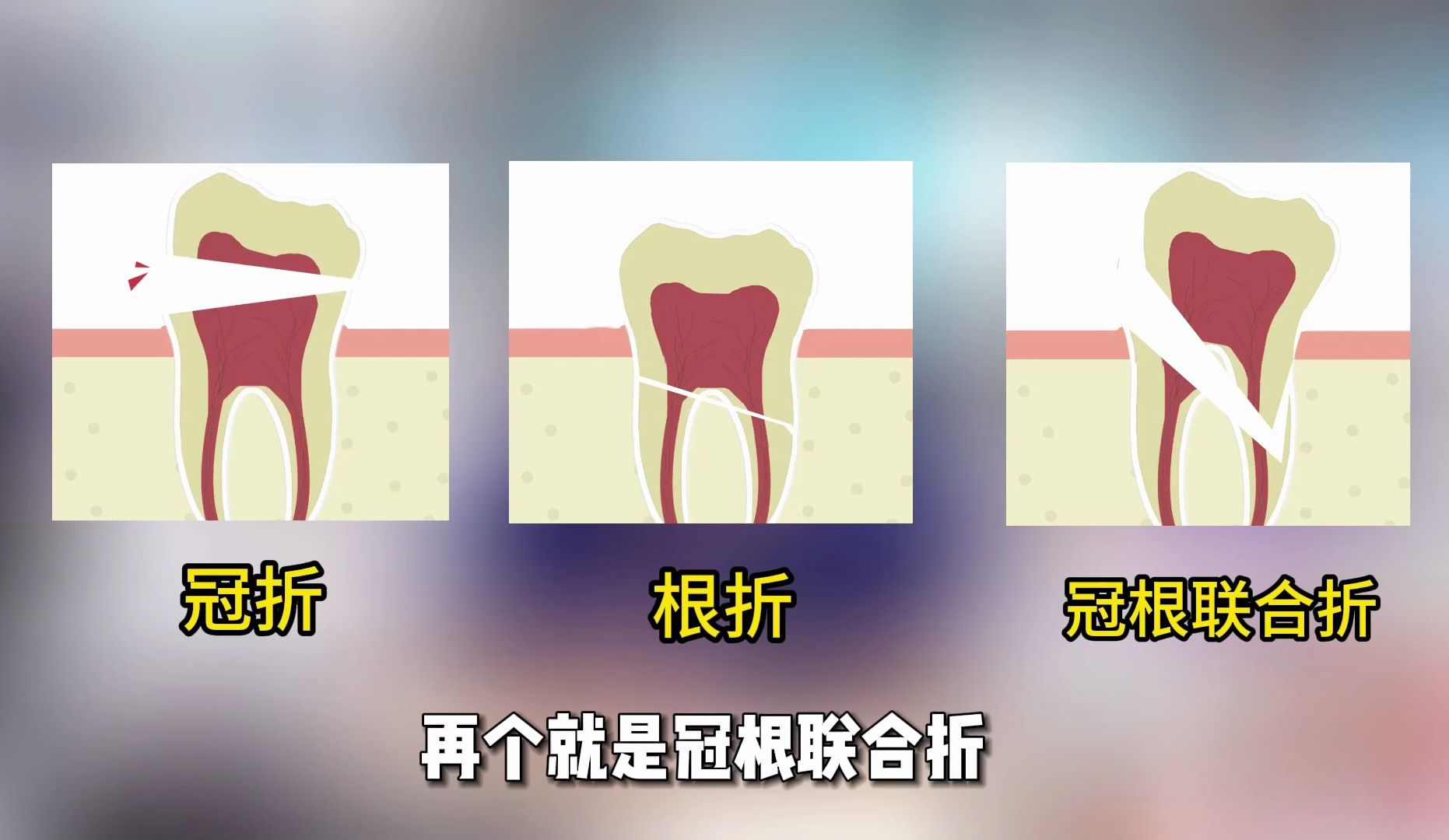 门牙牙冠卡折了,怎么处理?还能补救吗?