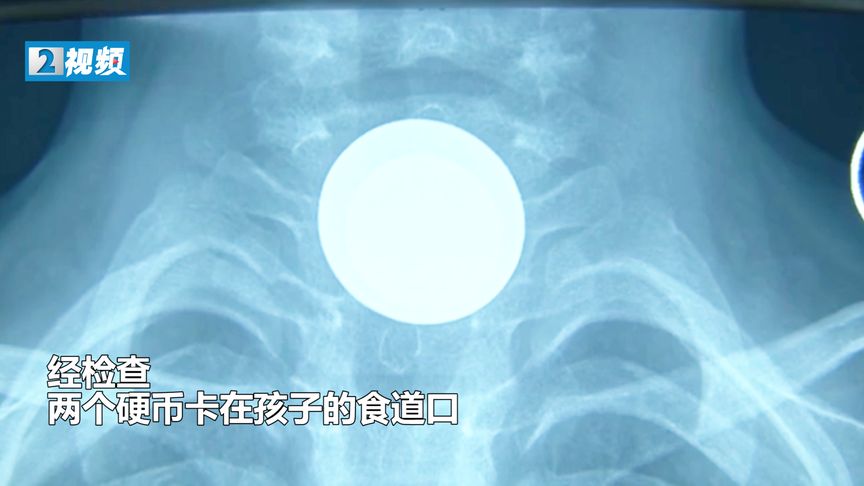 3岁男童吞下“1块1毛”!呕吐不止痛苦万分 爸爸:好像是被我吓的