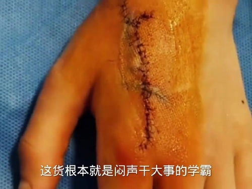 碘伏妙用:原来碘伏才是,消毒界的三好学生