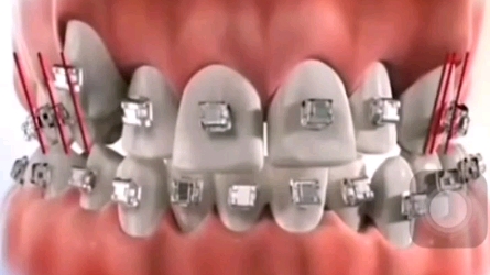 牙齿矫正全过程!视频讲解!