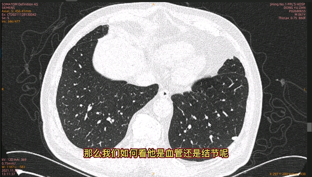 胸部CT基础:如何准确认识肺结节、纤维灶?和血管影如何鉴别?