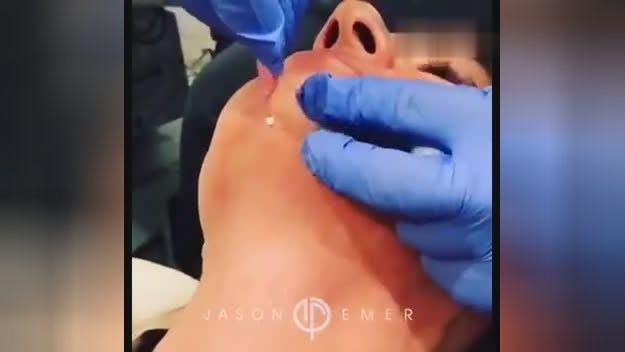 用戳针的方式刺激皮肤产生胶原蛋白,看着太痛了,为了漂亮厉害了