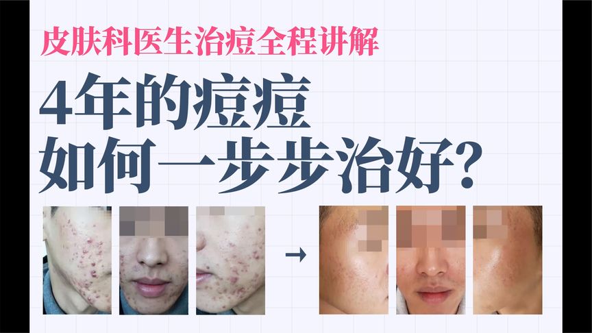 【皮肤科】全程分析!长了4年的痘痘是如何治好的?