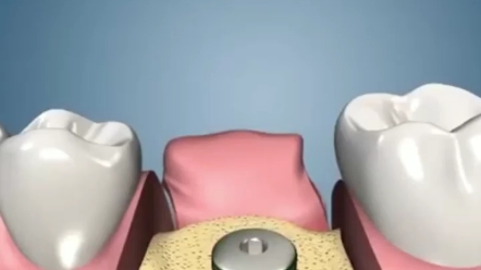 3d动画演示种植牙过程