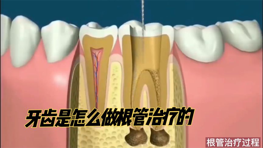 根管治疗的过程是怎样的?