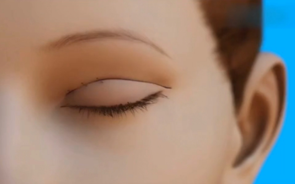 3D视频演示:双眼皮手术全过程