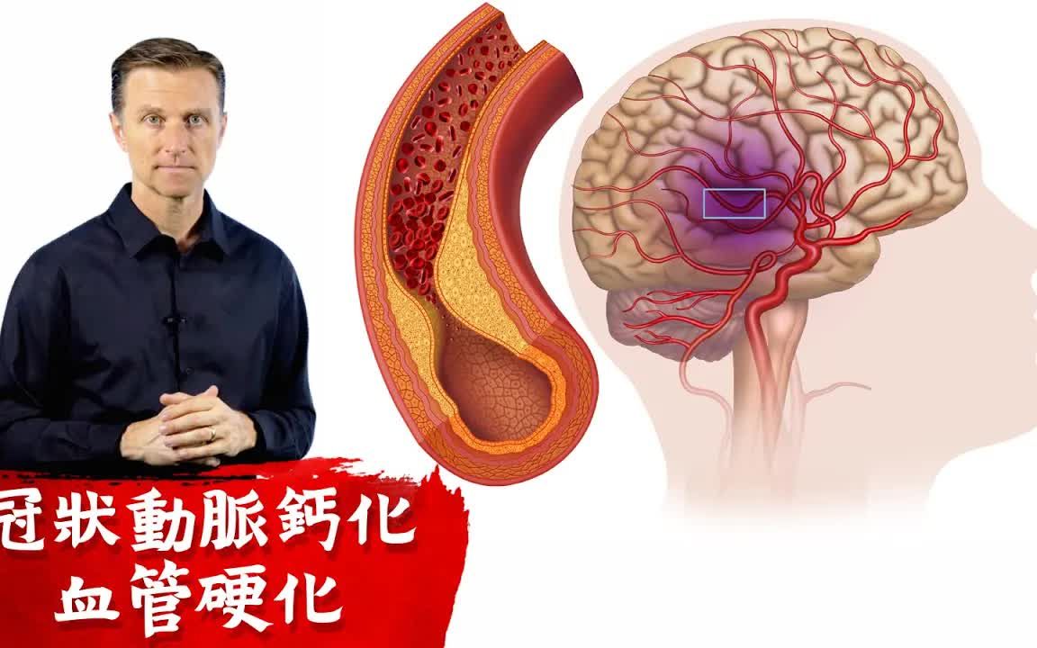 血管硬化,冠状动脉钙化(CAC)检查,自然疗法,柏格医生dr berg