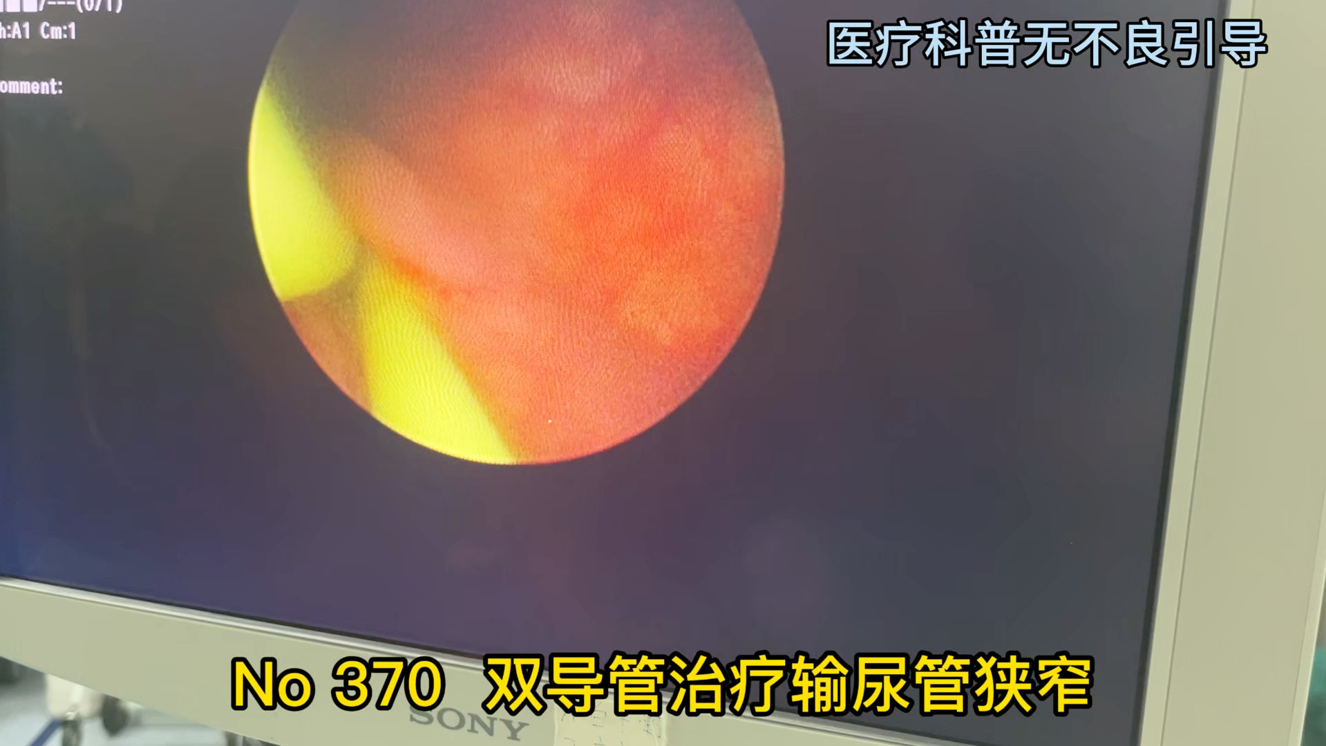 应用输尿管双导管技术治疗复杂性输尿管狭窄