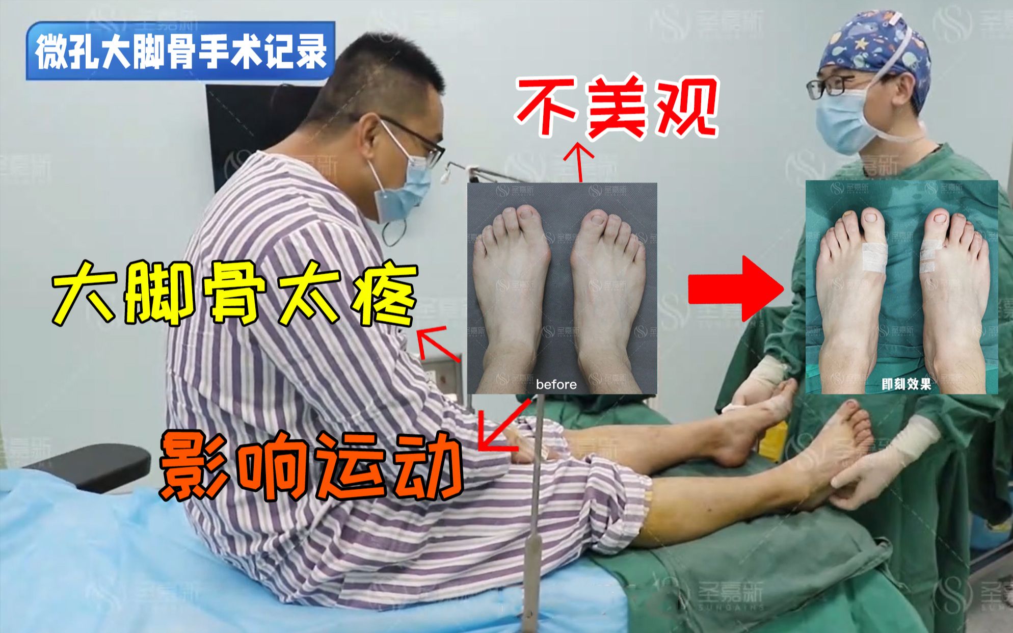 北京苏敬达医生:男人拇外翻大脚骨也痛苦:影响运动,太疼难忍!微孔手术...