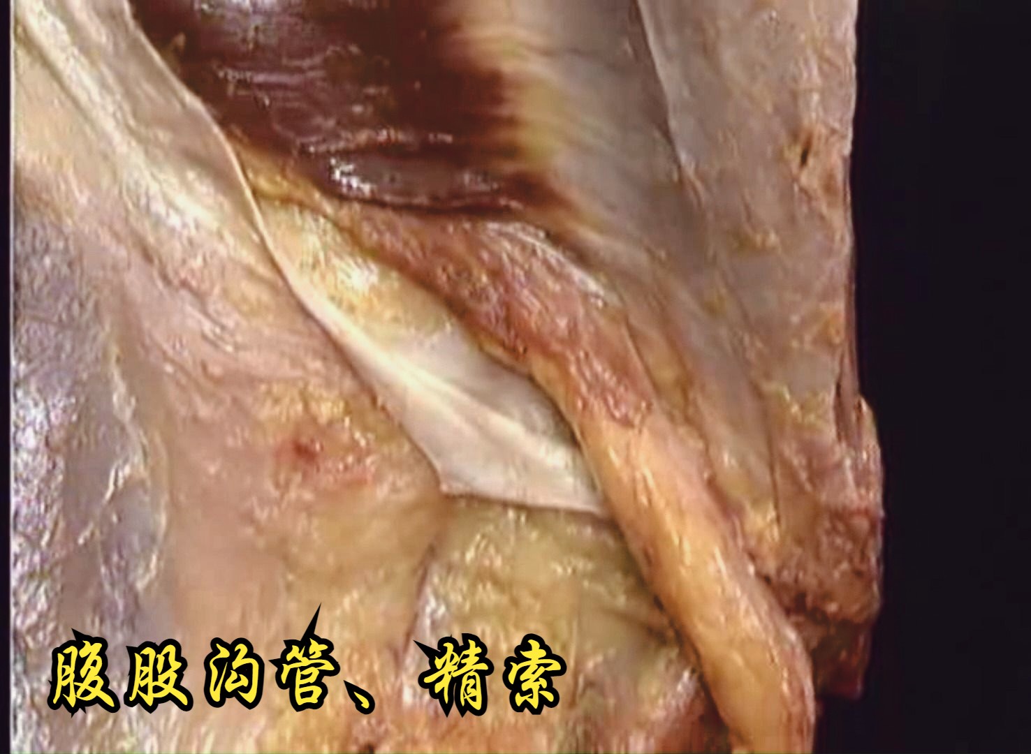 腹股沟管、精索