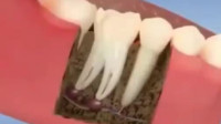根管治疗术是怎么治疗的呢?