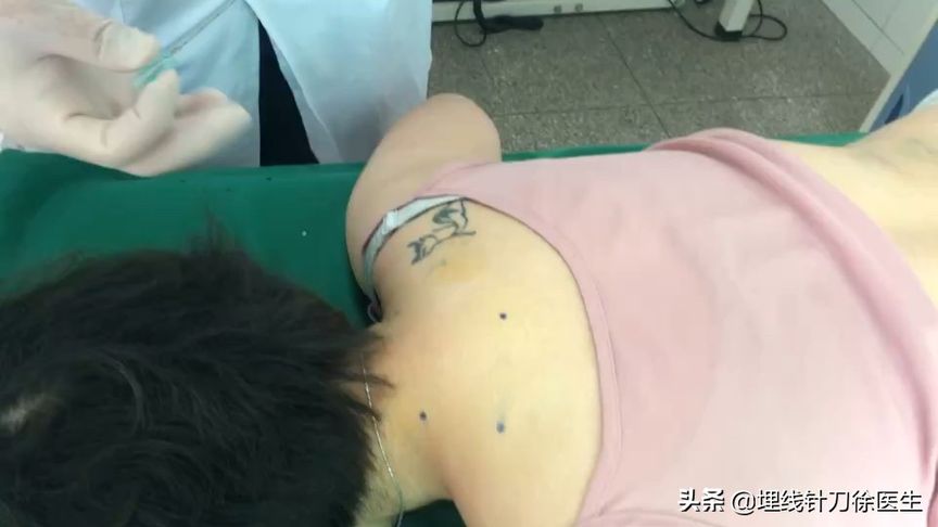 颈椎病、富贵包的埋线针刀治疗