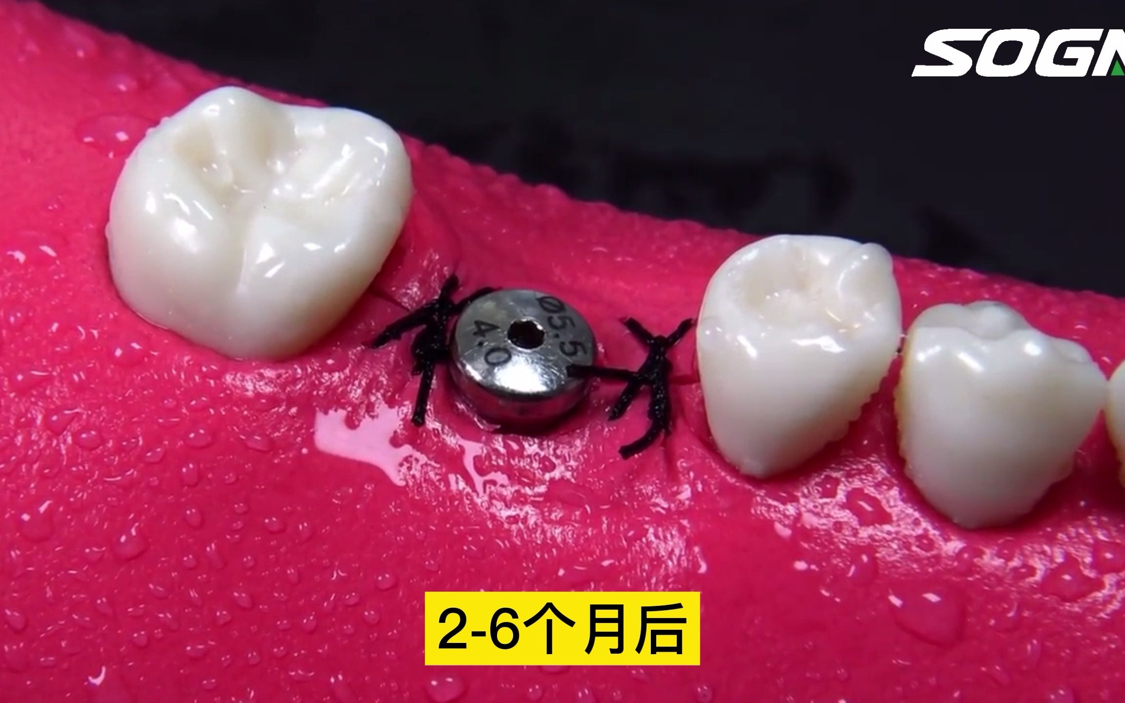 高清种植牙体全过程