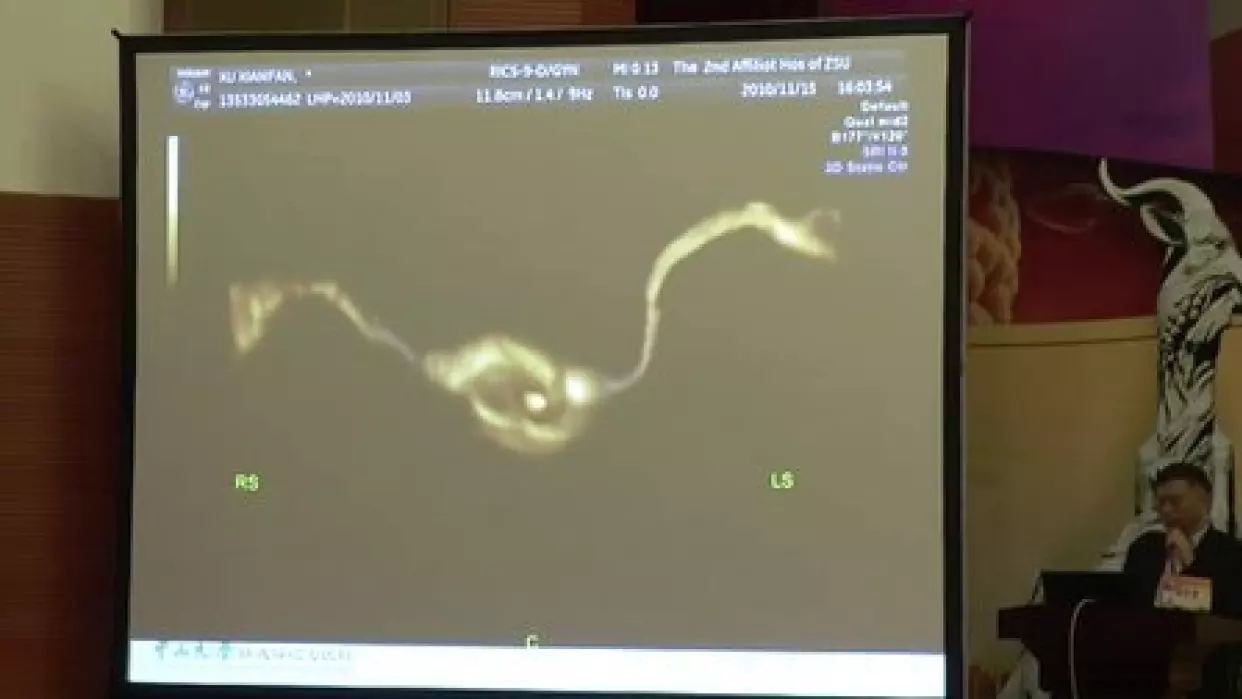 输卵管动态三维超声造影阳性结果分析与建议(6:00开始)-周力学