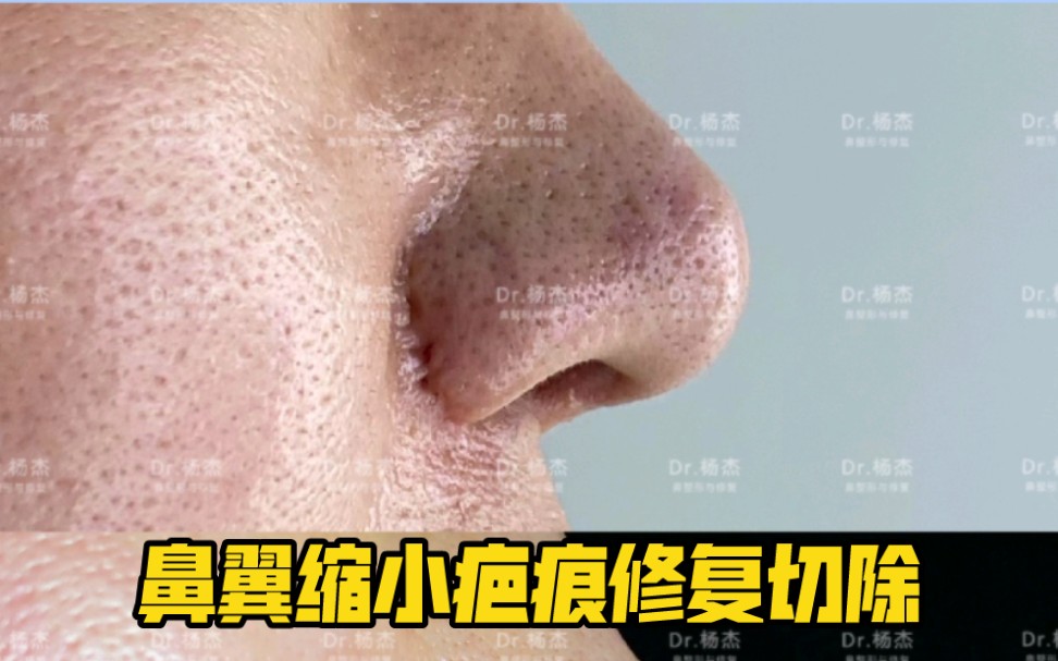鼻翼疤痕修复切除+鼻翼缩小