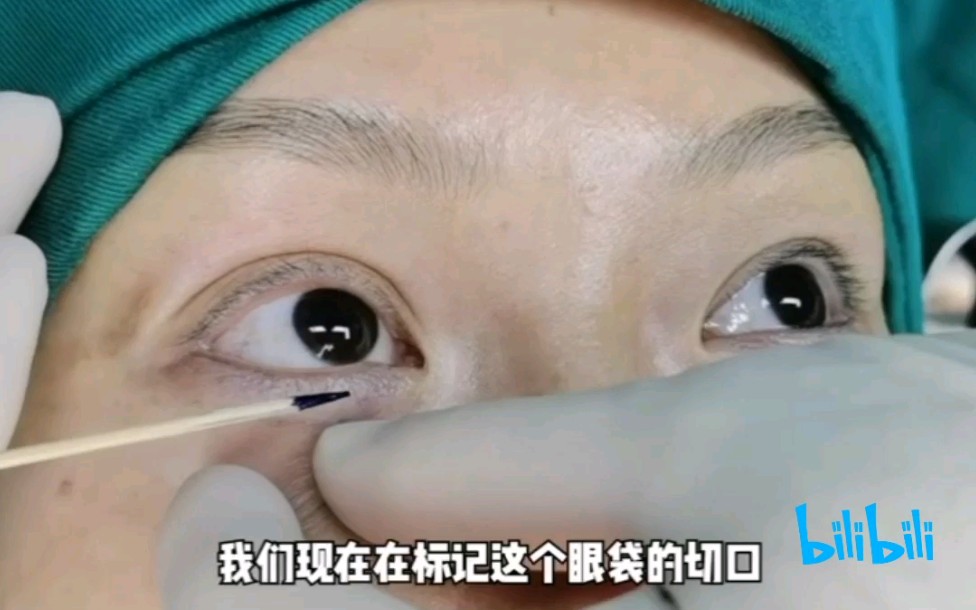 【科普】祛眼袋+卧蚕缩小术的划线过程(何祯平)