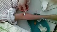 拍摄国内医学picc拔管