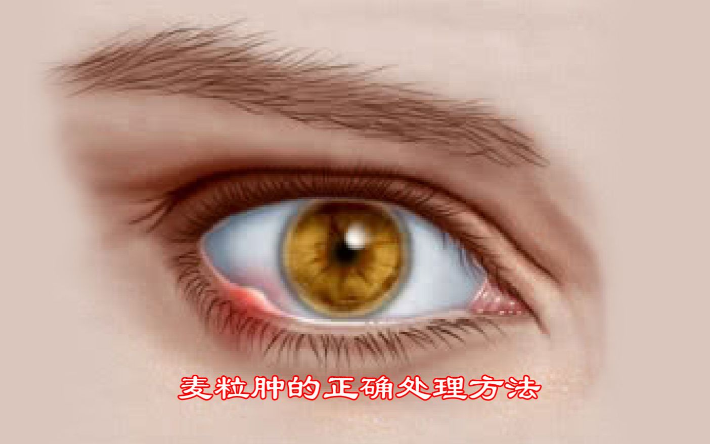 麦粒肿的正确处理办法!