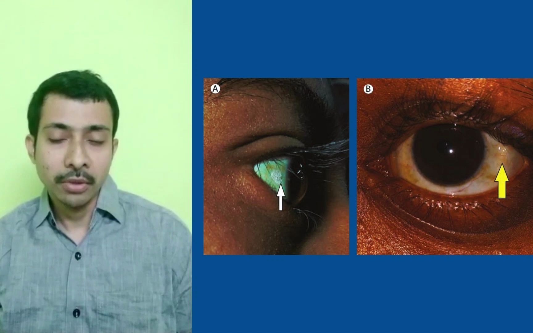 通过毕脱斑、干眼症、夜盲症病变鉴别维生素A缺失|Lancet