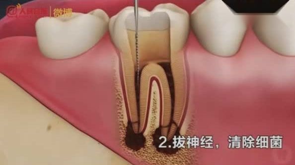 牙齿根管治疗动画视频,看着都疼到抽抽,我默默刷牙去了