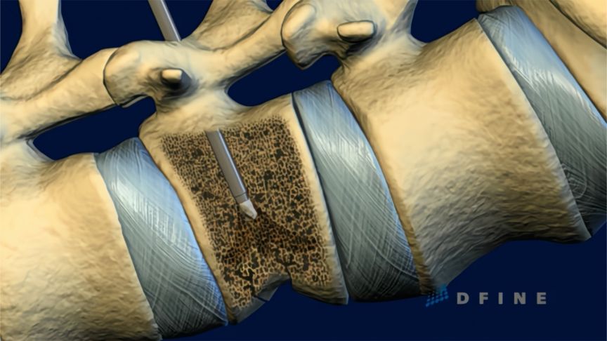 脊柱骨折稳定椎体治疗视频