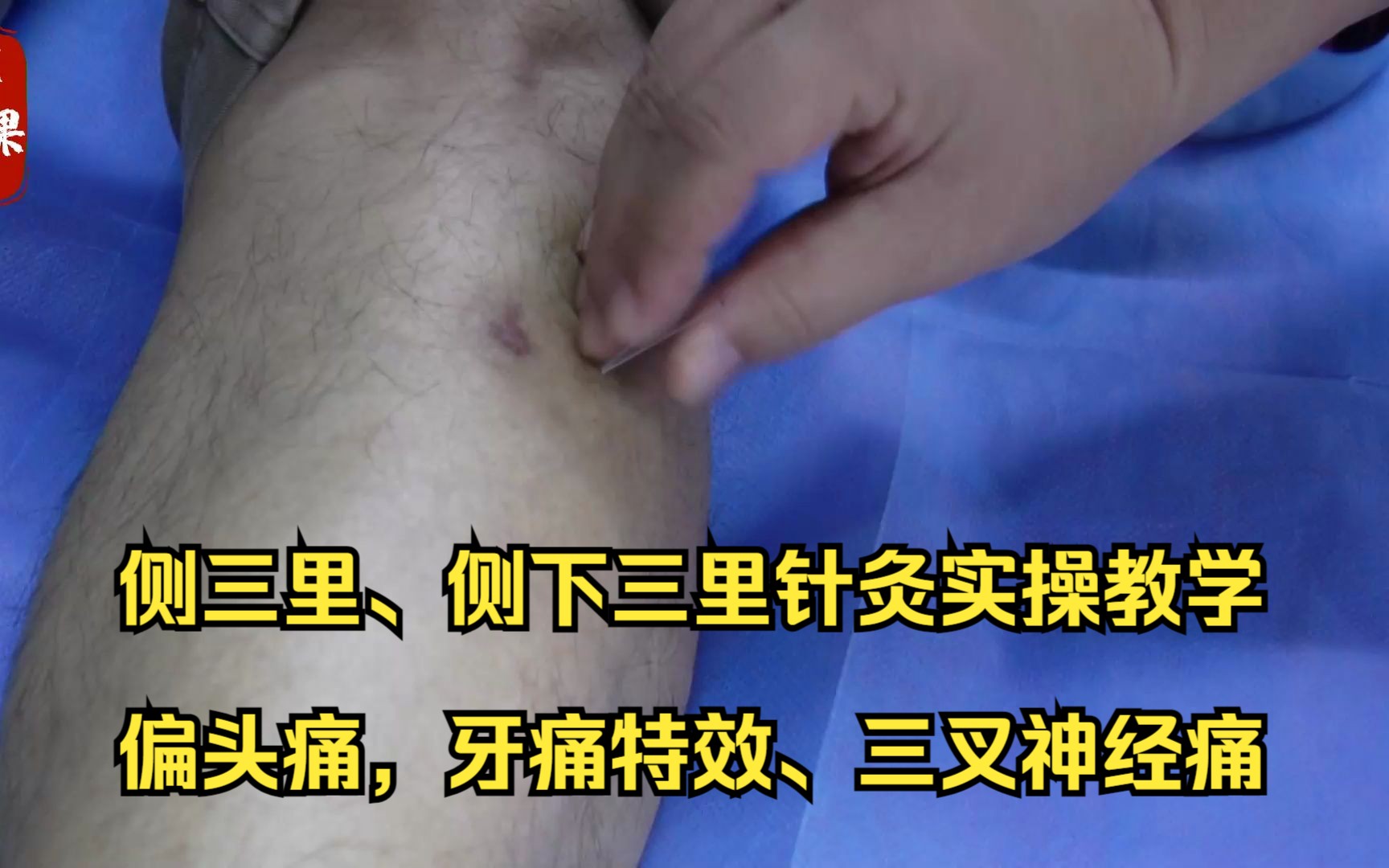 侧三里、侧下三里针灸实操教学,偏头痛,牙痛特效、三叉神经痛