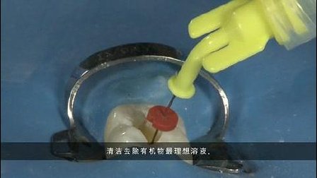 微创根管治疗操作的全过程 , 大家可以透过这个操作视频更加了解根管...