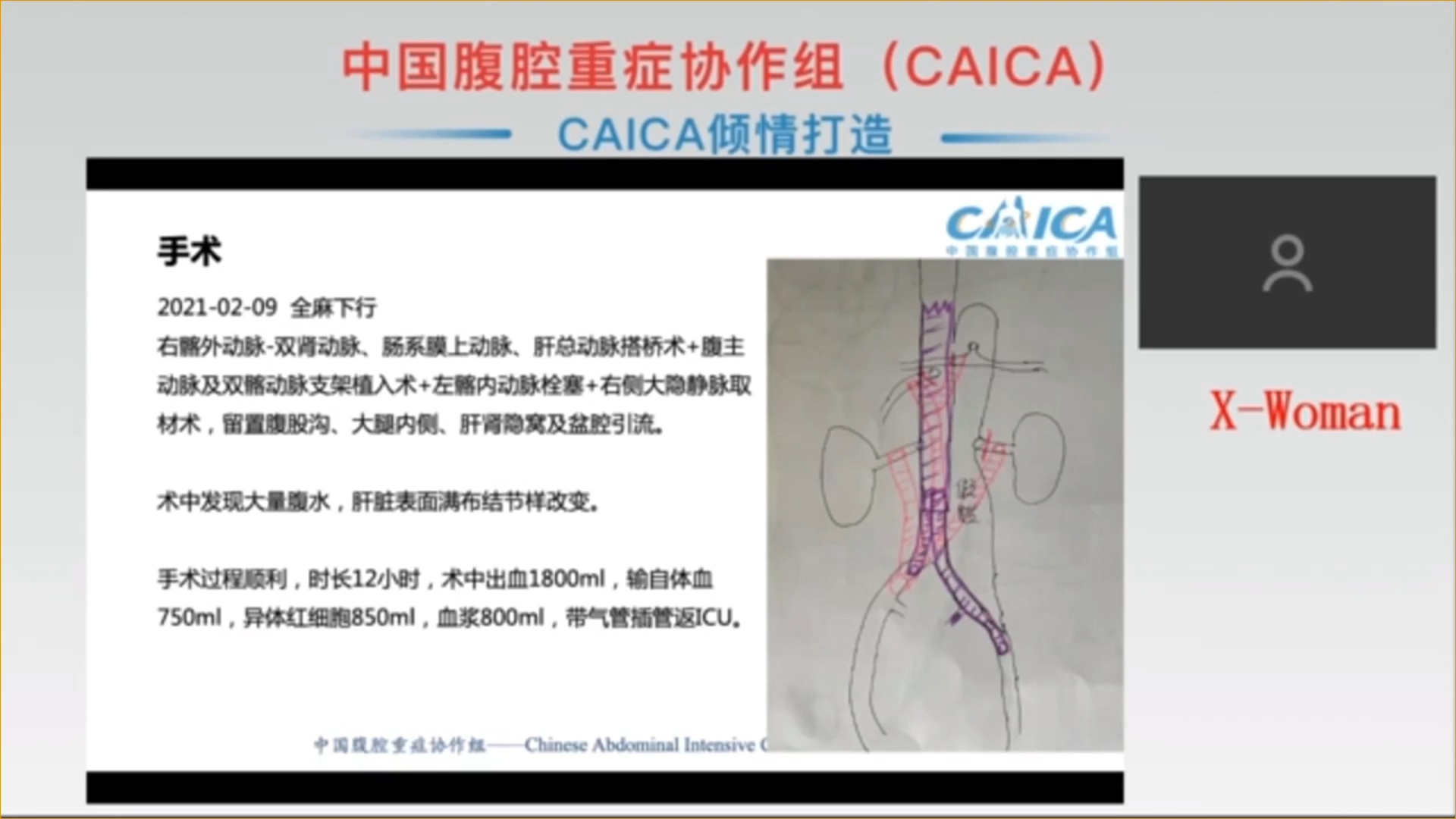 夹层术后重症疑难病例讨论