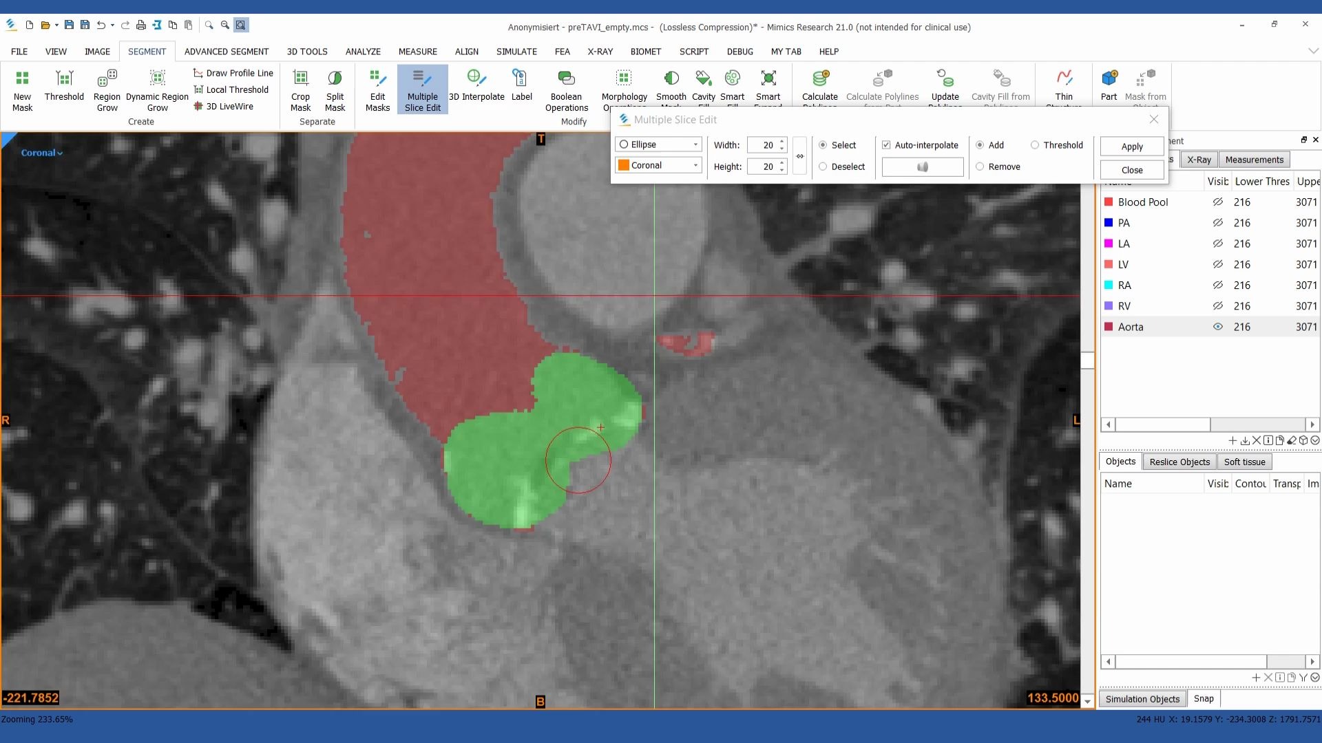 使用mimics进行TAVI测量