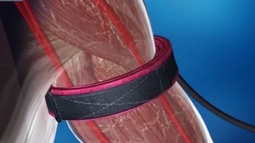 使用四肢加压运动,可辅助产生适度缺血,提高运动效率