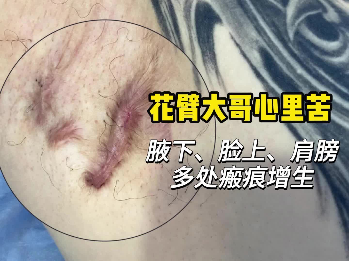 花臂大哥纹身为了遮住疤痕,奈何疤痕增生越长越多,治愈后送锦旗