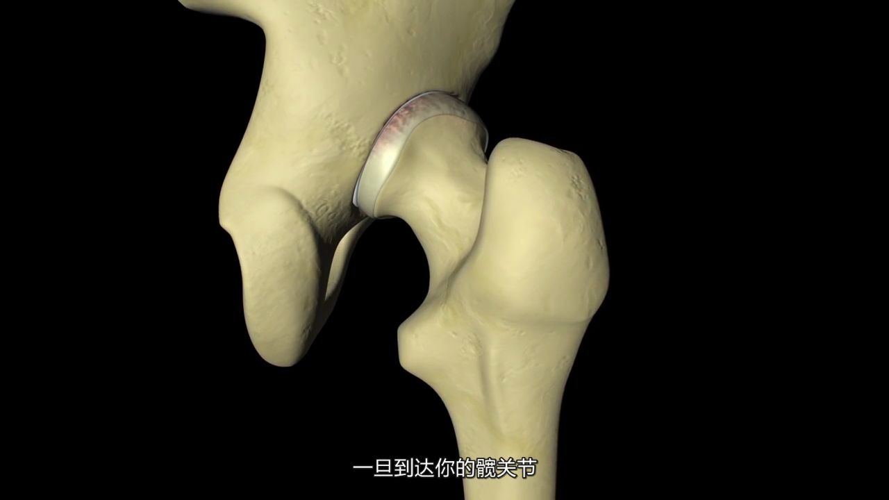 【3D医学动画】髋关节置换术