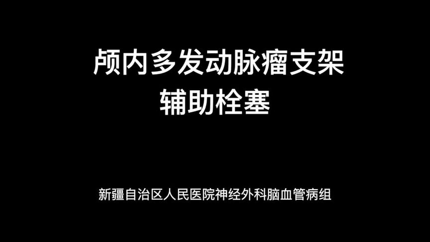 脑动脉瘤的神经血管内介入治疗是一种微创、安全