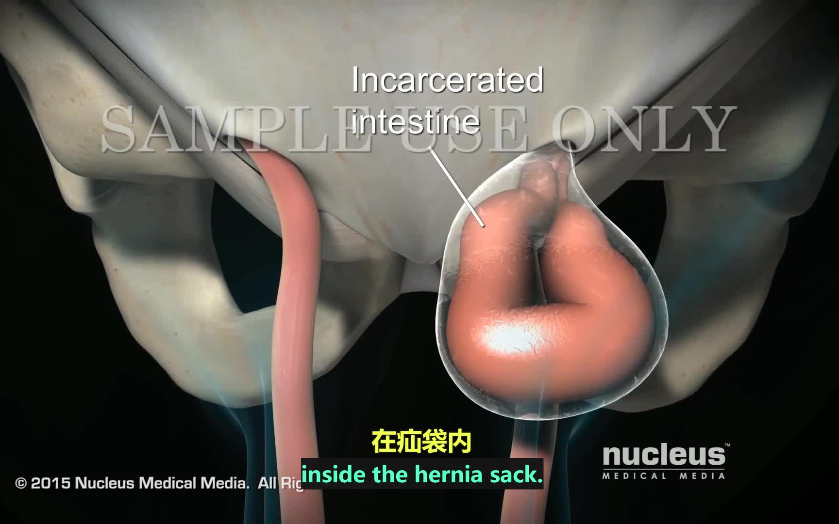 【3D医学动画】疝气(中英双字幕+原版英文)