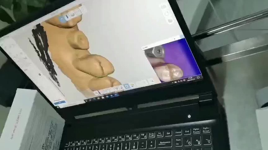 数字化口腔扫描,告别传统取模的种种不适