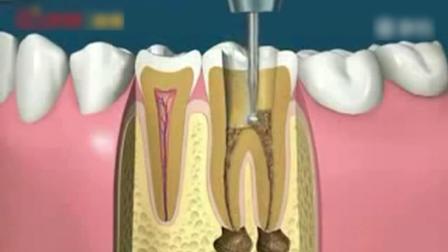 看完赶快去刷牙! 动画展示看着就很酸爽的着都疼的牙齿根管治疗术