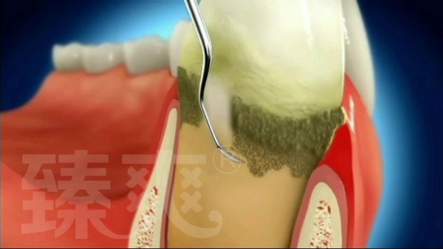 龈下刮治3D演示(声明:本视频号所有科普视频仅供参考