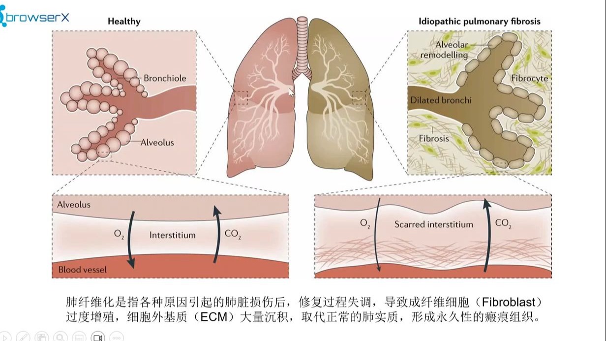 利用BBrowserX Pro探索肺纤维化疾病分子机制