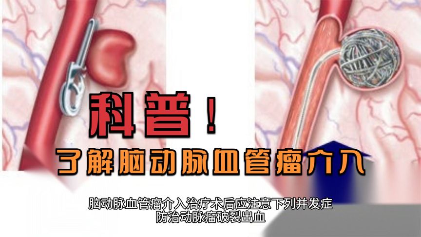 科普!了解脑动脉血管瘤介入手术